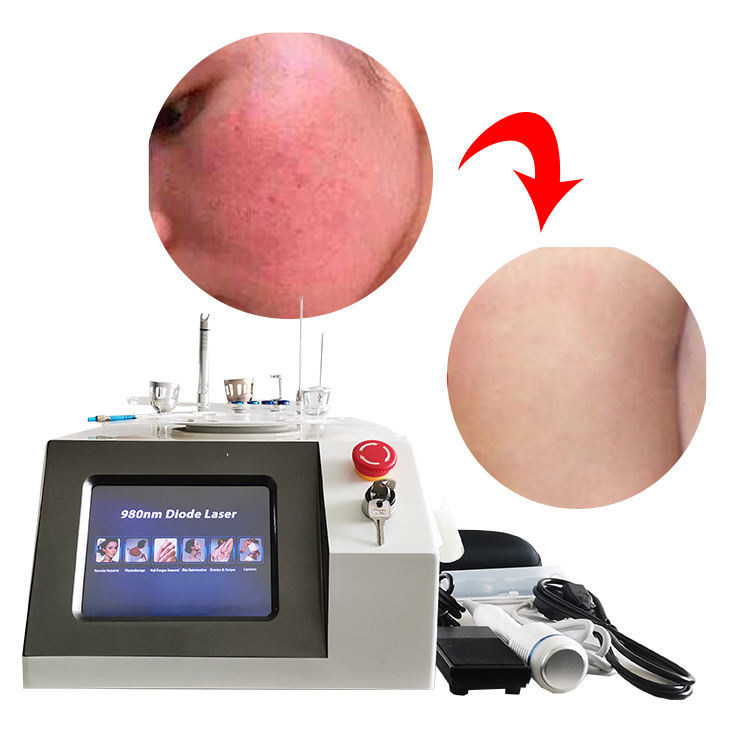 6 In 1 Spider Vein Laser Machine , 980nm Face Vascular Treatment ...